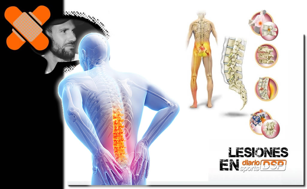 Lumbalgia: ¿Qué es?, ¿Cómo prevenirla o tratarla? - DiarioSports - San ...